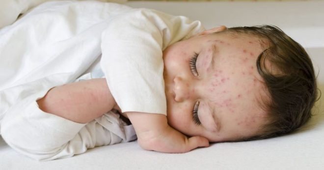 himlő - Gyerekszoba